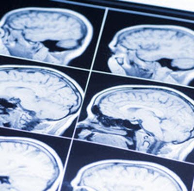 Understanding Traumatic Brain Injuries - Symptoms & Recovery